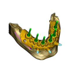 Implantologie: implanteren zonder zorgen - Implacom BV